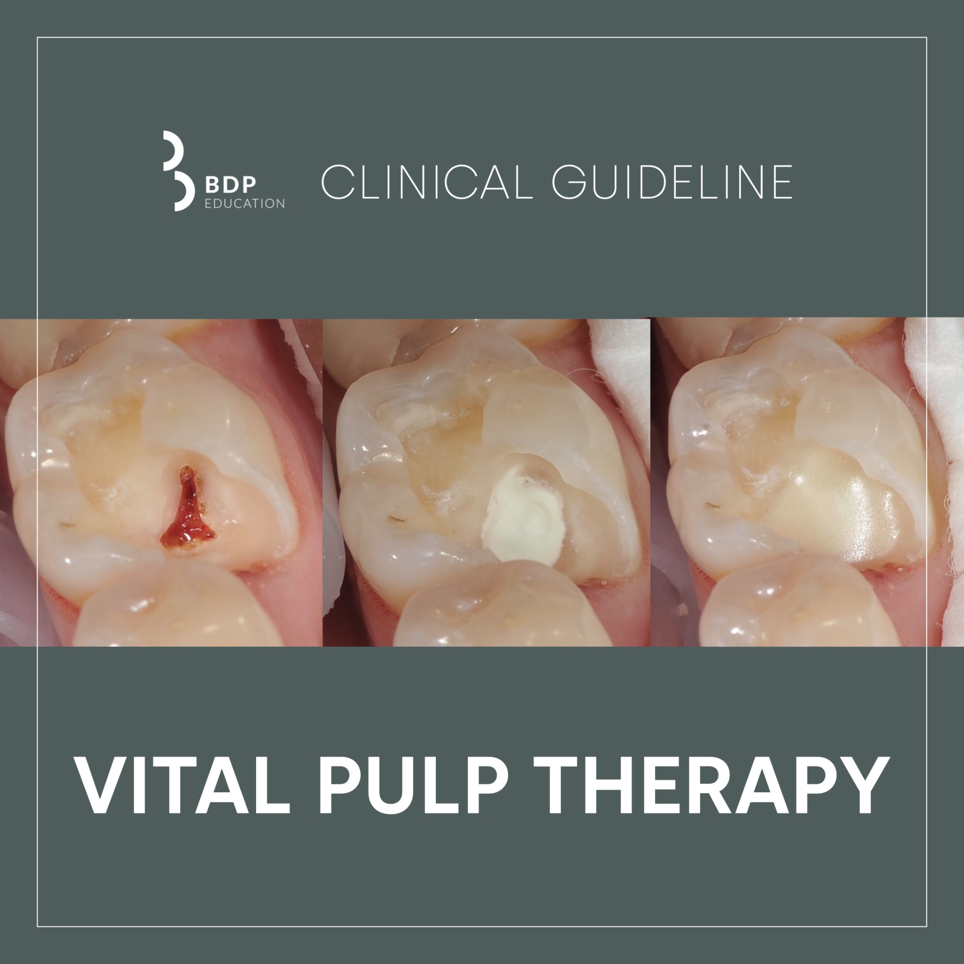Vital Pulp Therapy :: bdpeducation